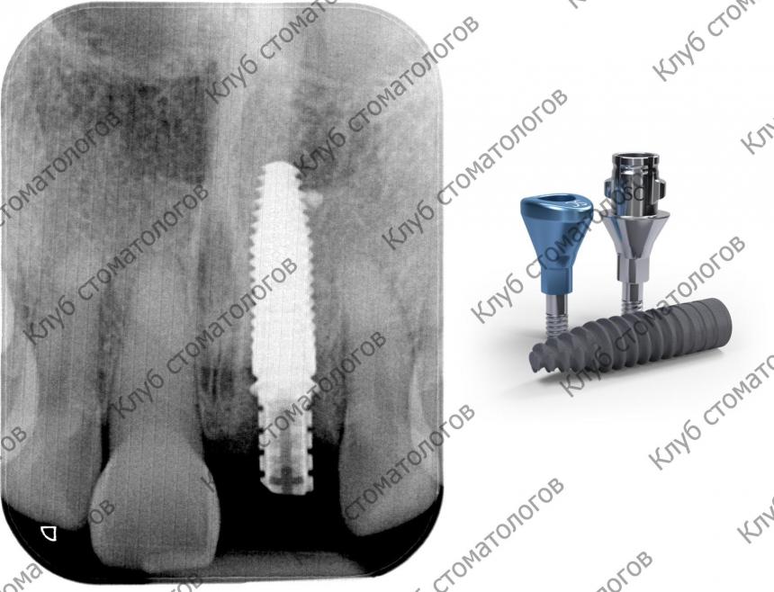 Straumann Bone Level Tapered (2756) - Энциклопедия имплантатов ...